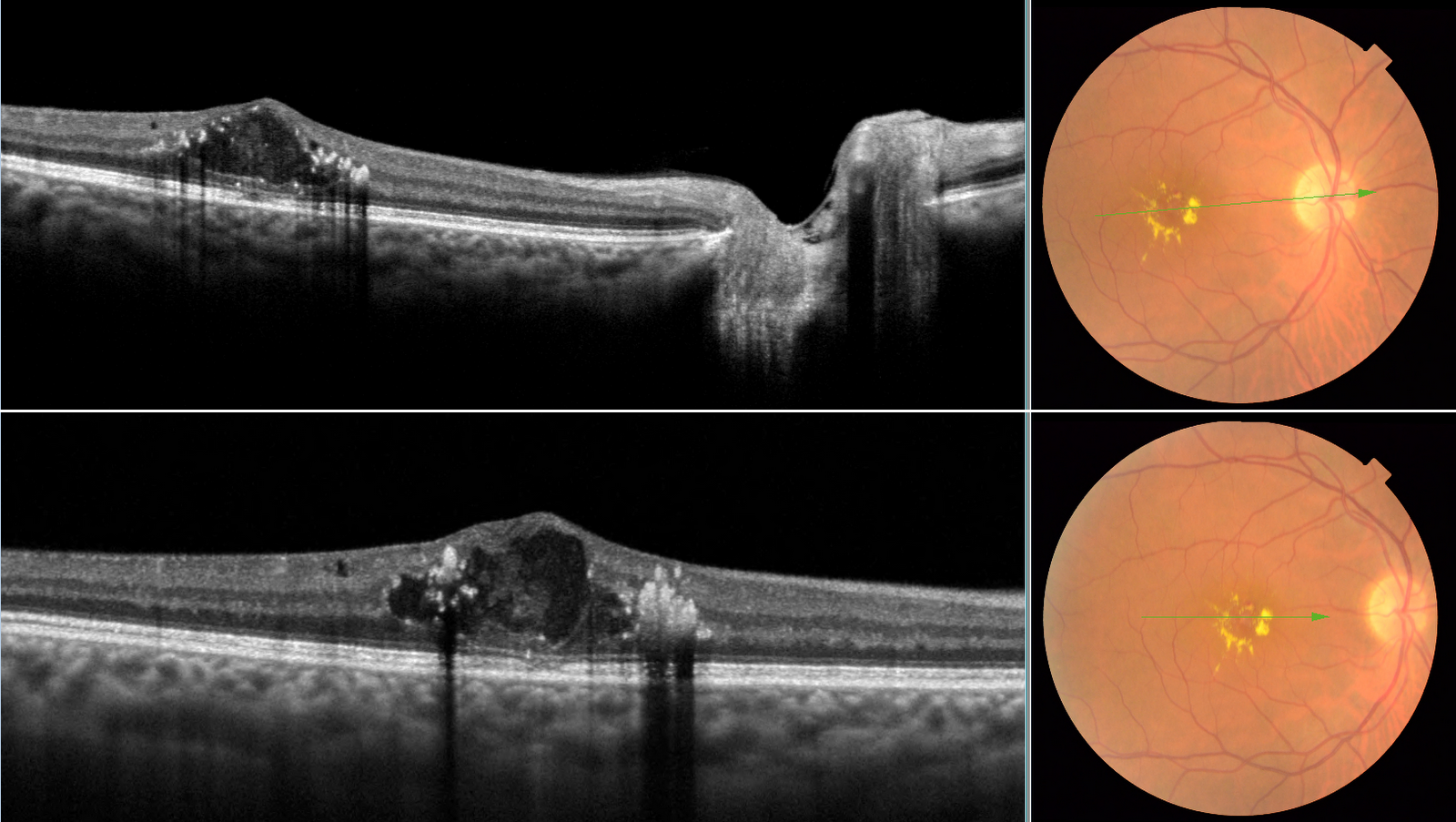 Anillo Exudados y Edema Macular Diabético - Farmacosalud