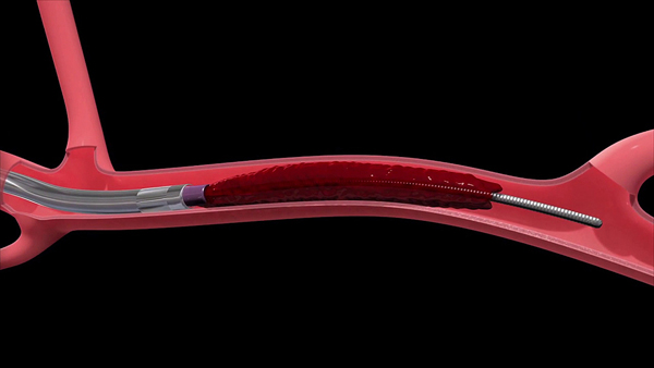 Un nuevo método intraarterial mejora recuperación en ictus isquémico