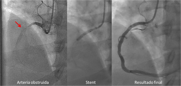 Colocación stent - Farmacosalud