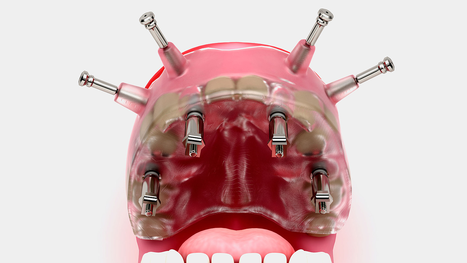 primera férula quirúrgica y colocación de implantes 4D - Farmacosalud