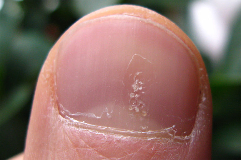 (portada) psoriasis en la uña ungueal - Farmacosalud