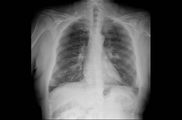 Rx1 Asma Grave Asma Grave Farmacosalud