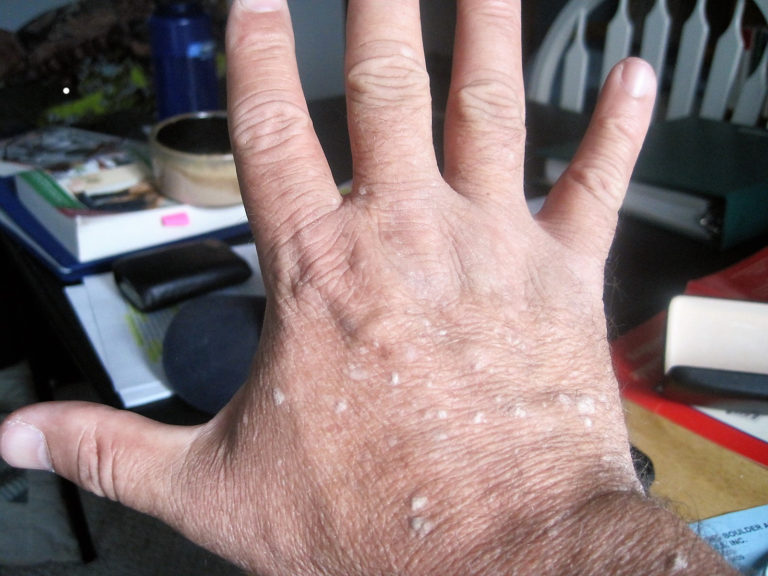 VERRUGAS mano - Farmacosalud