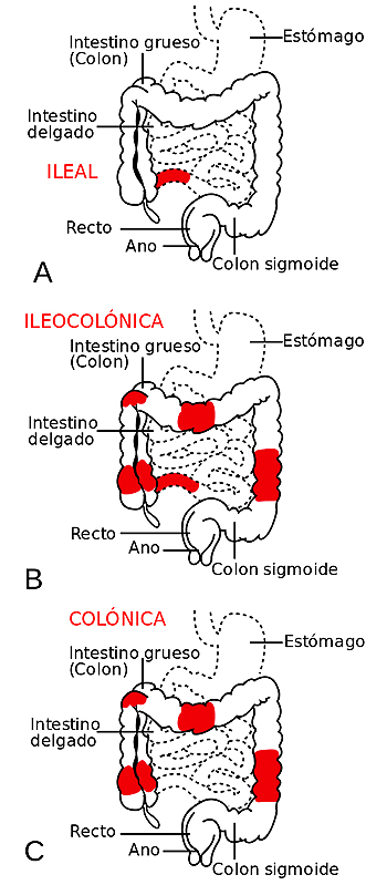 Abordaje endoscópico de la EII. Avances