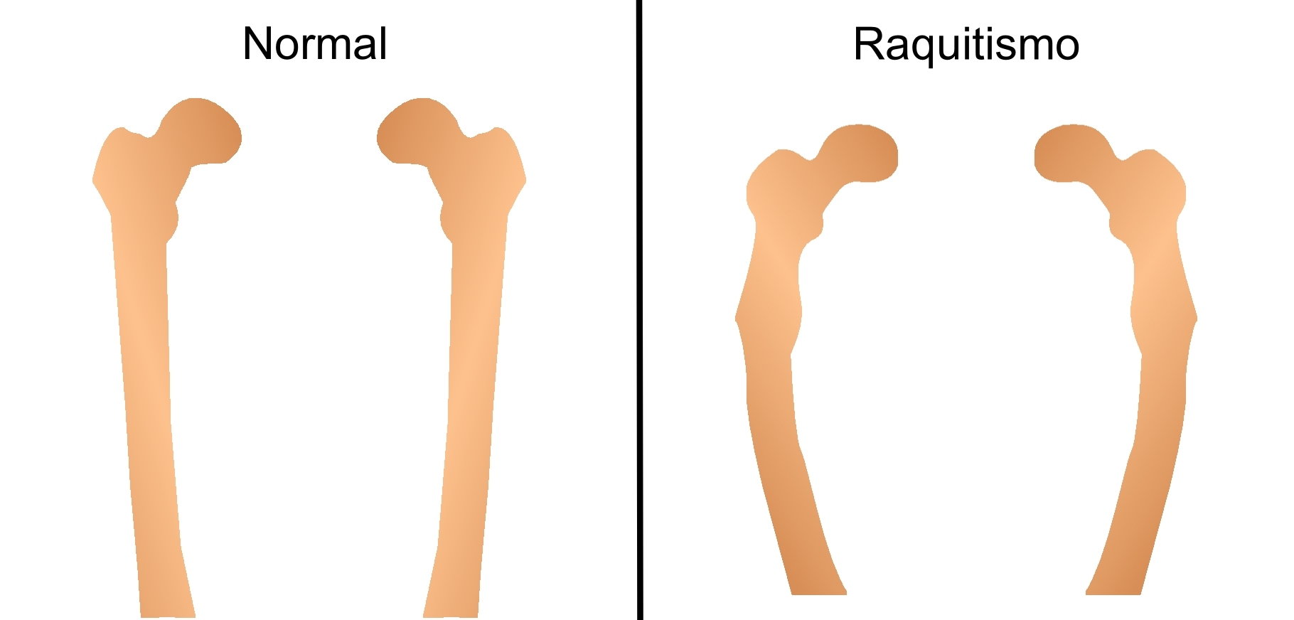 Raquitismo déficit vitamina D - Farmacosalud