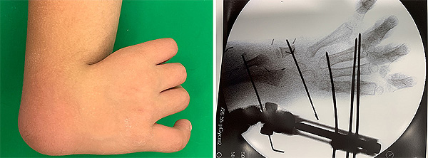 (600) Displasia Radial 2 mano zamba y técnica Vilkki - Farmacosalud