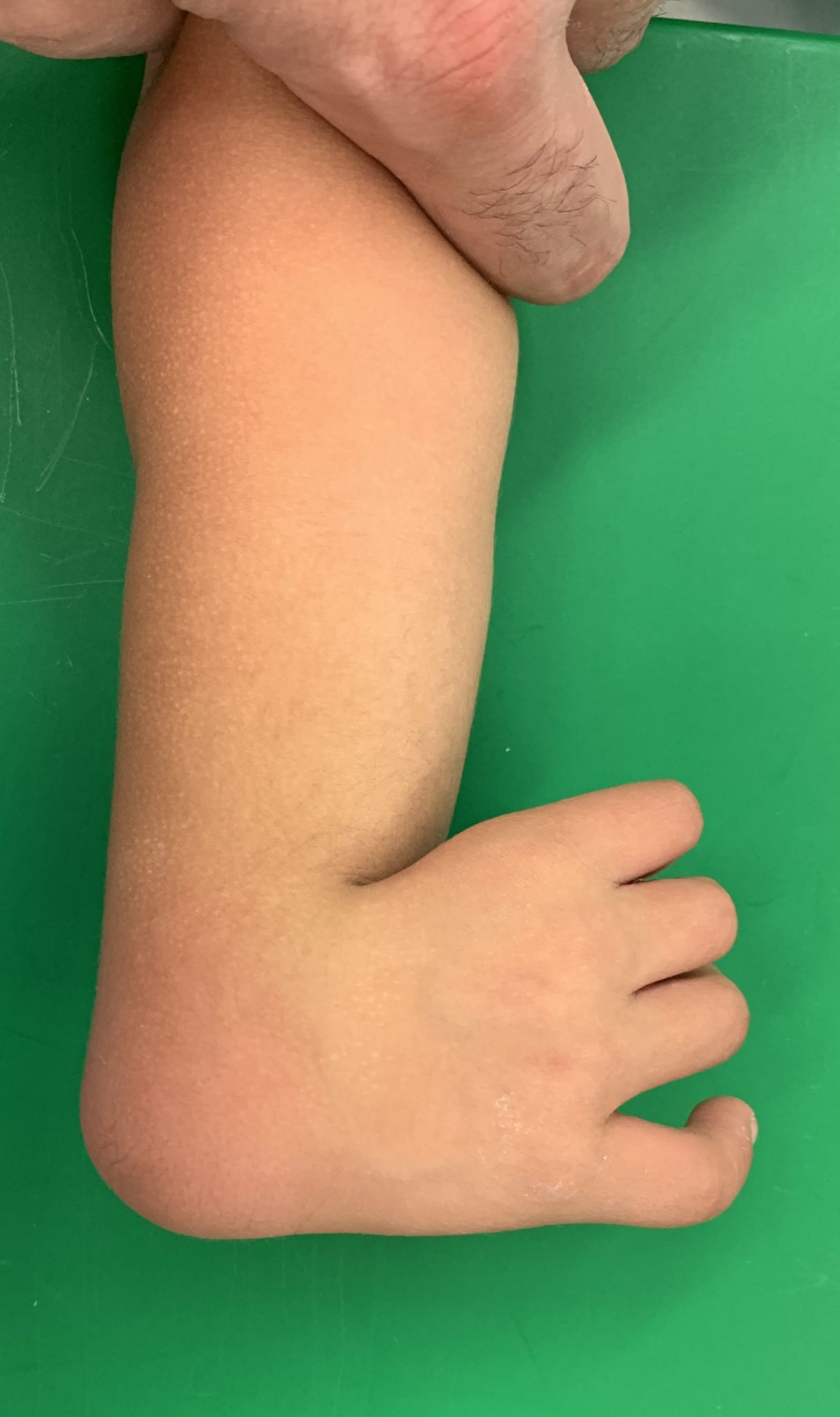 Displasia Radial 2 mano zamba - Farmacosalud