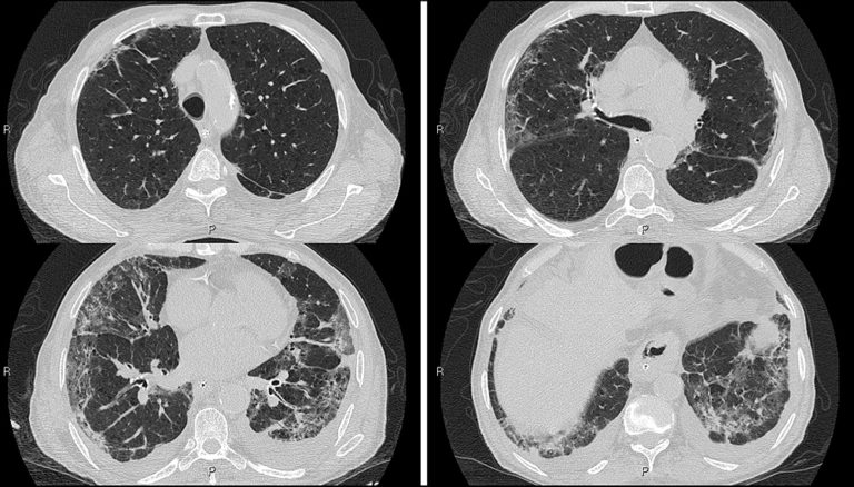 (portada) imagen TC de paciente con COVID 19 - Farmacosalud